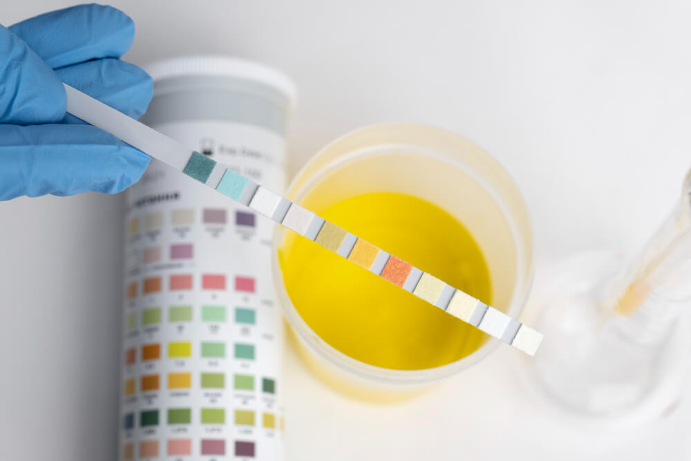 Find Out What Urine Test Can Detect